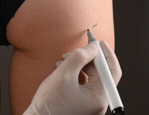 Butt fillers and hip dips - Elite Life Medical Centre